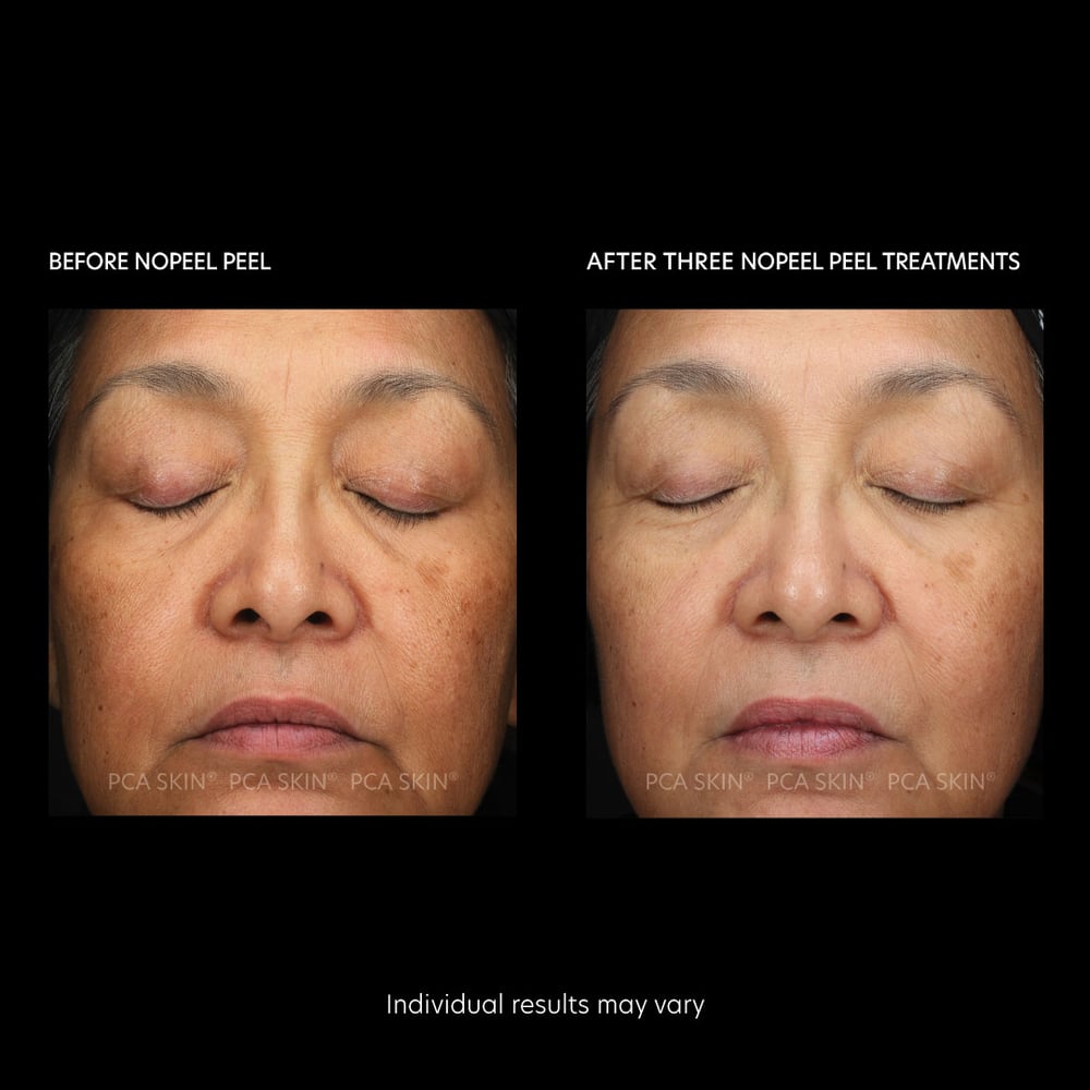 Never fear- the NoPeel Peel is here!